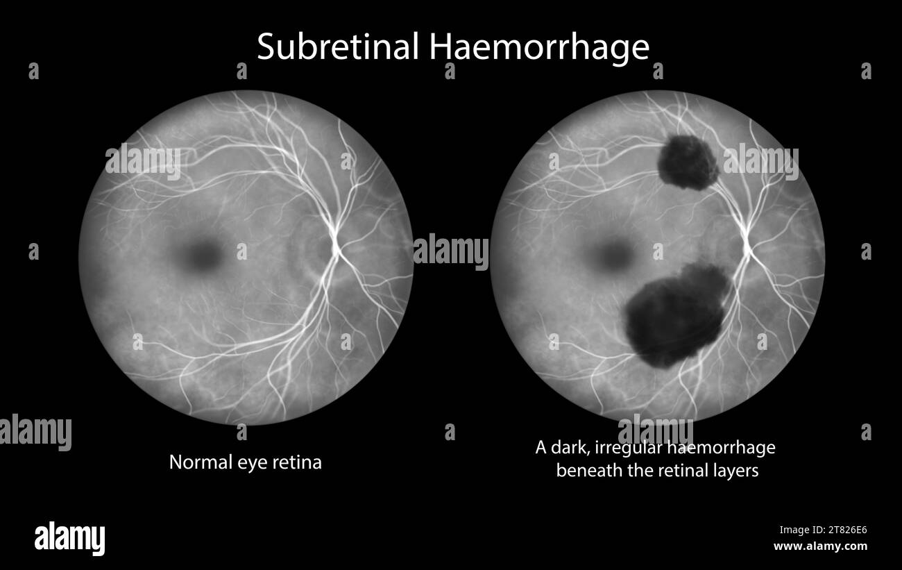 Subretinal haemorrhage on the retina, illustration Stock Photo - Alamy
