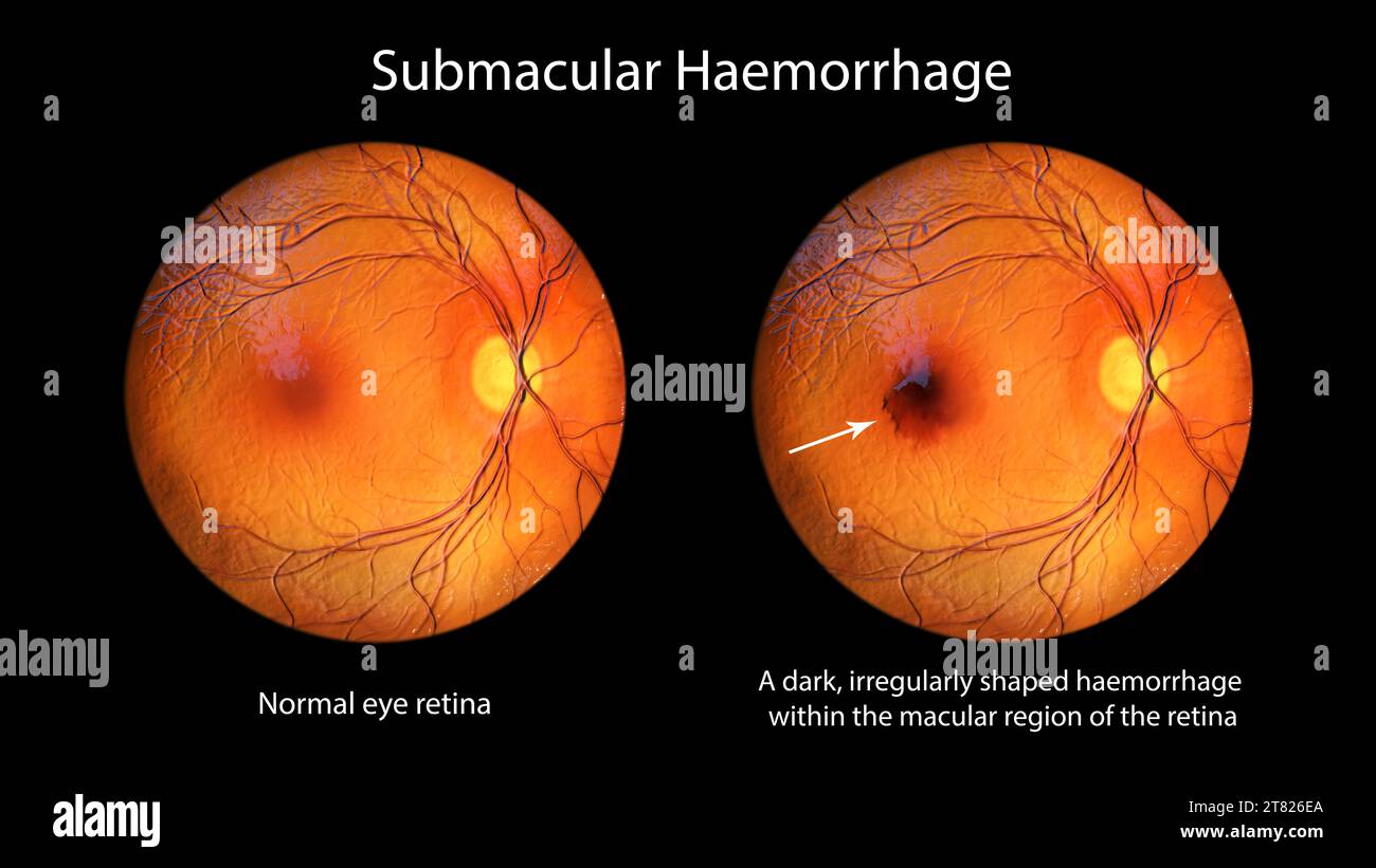 Submacular haemorrhage on the retina, illustration Stock Photo - Alamy