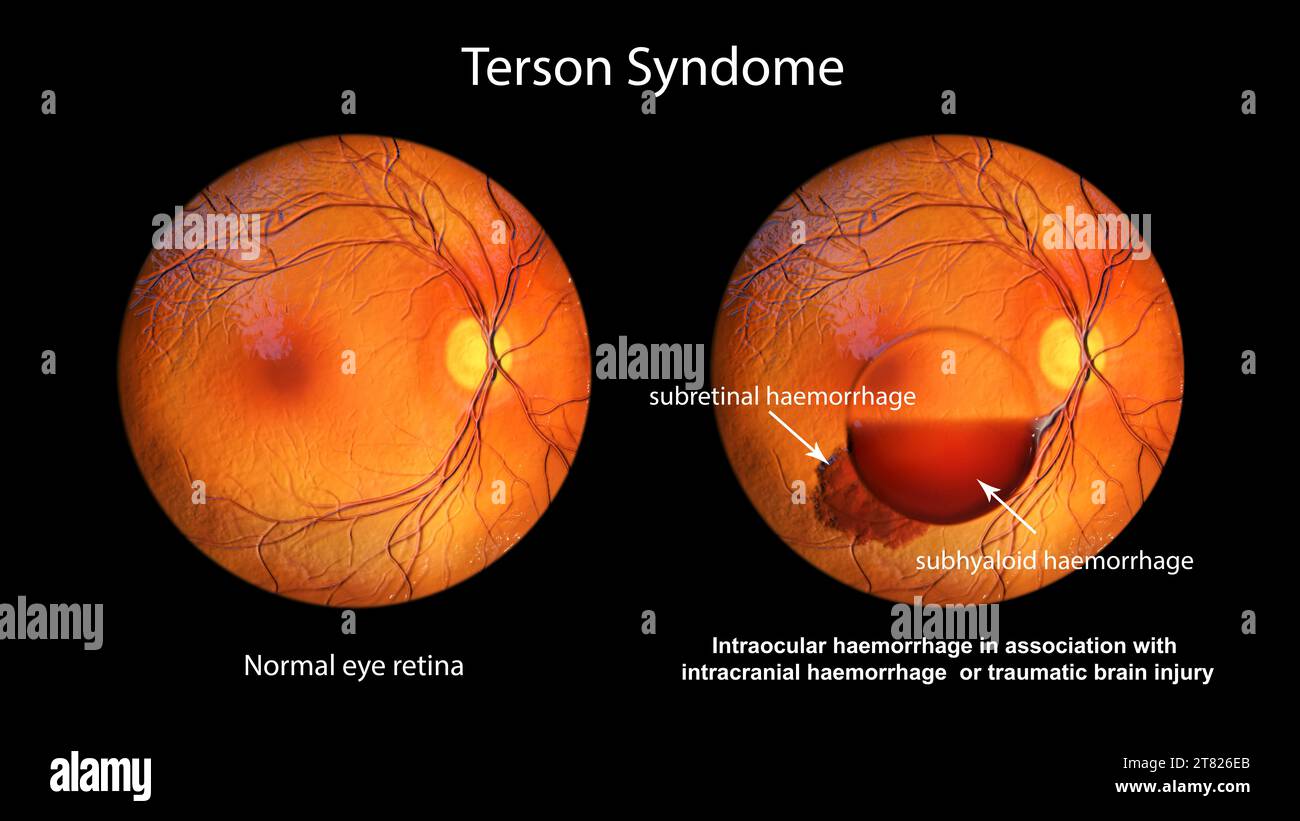 Intraocular haemorrhage in Terson syndrome, illustration Stock Photo ...