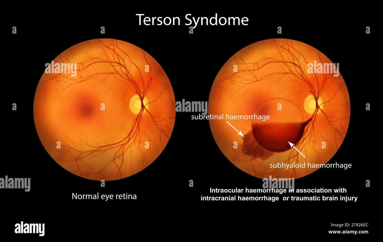 Intraocular haemorrhage in Terson syndrome, illustration Stock Photo ...