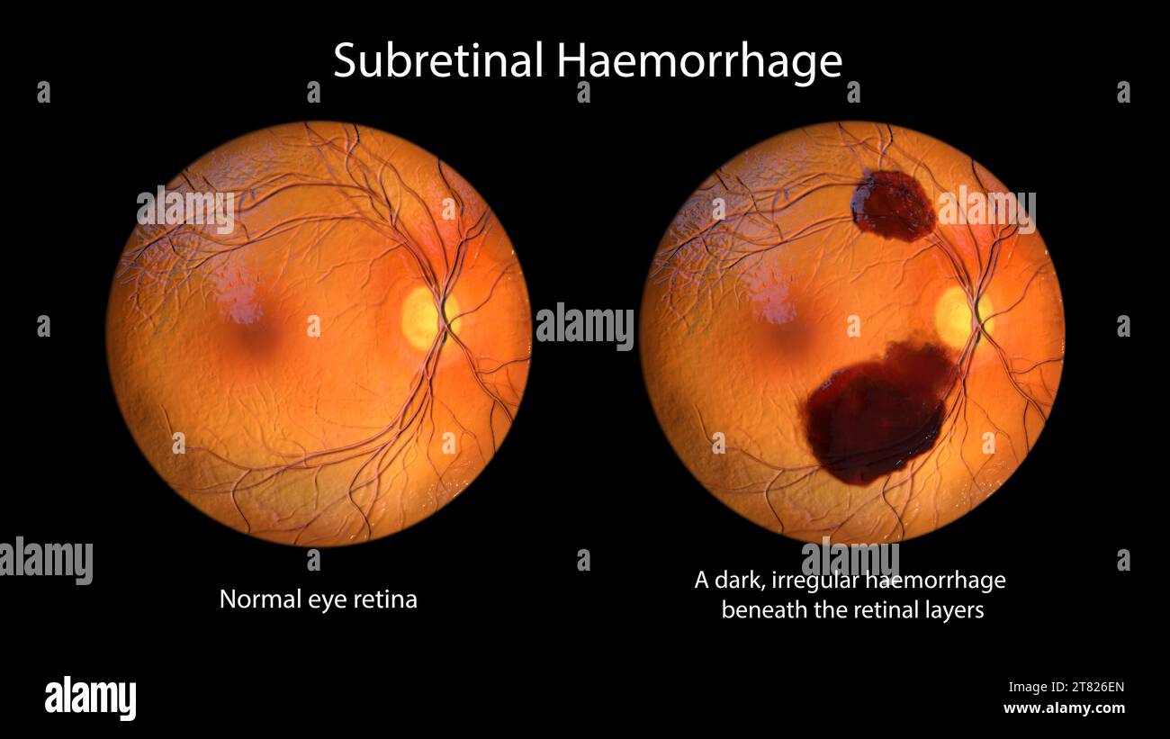 Subretinal haemorrhage on the retina, illustration Stock Photo - Alamy