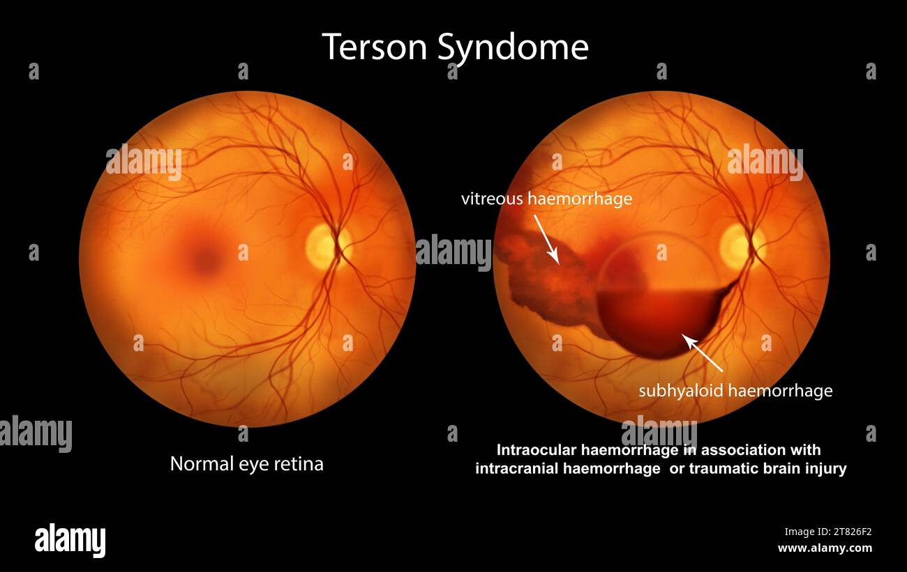 Intraocular haemorrhage in Terson syndrome, illustration Stock Photo ...