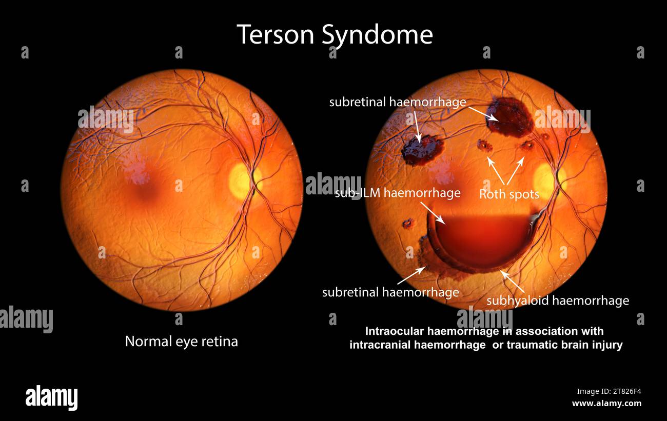 Intraocular haemorrhage in Terson syndrome, illustration Stock Photo ...
