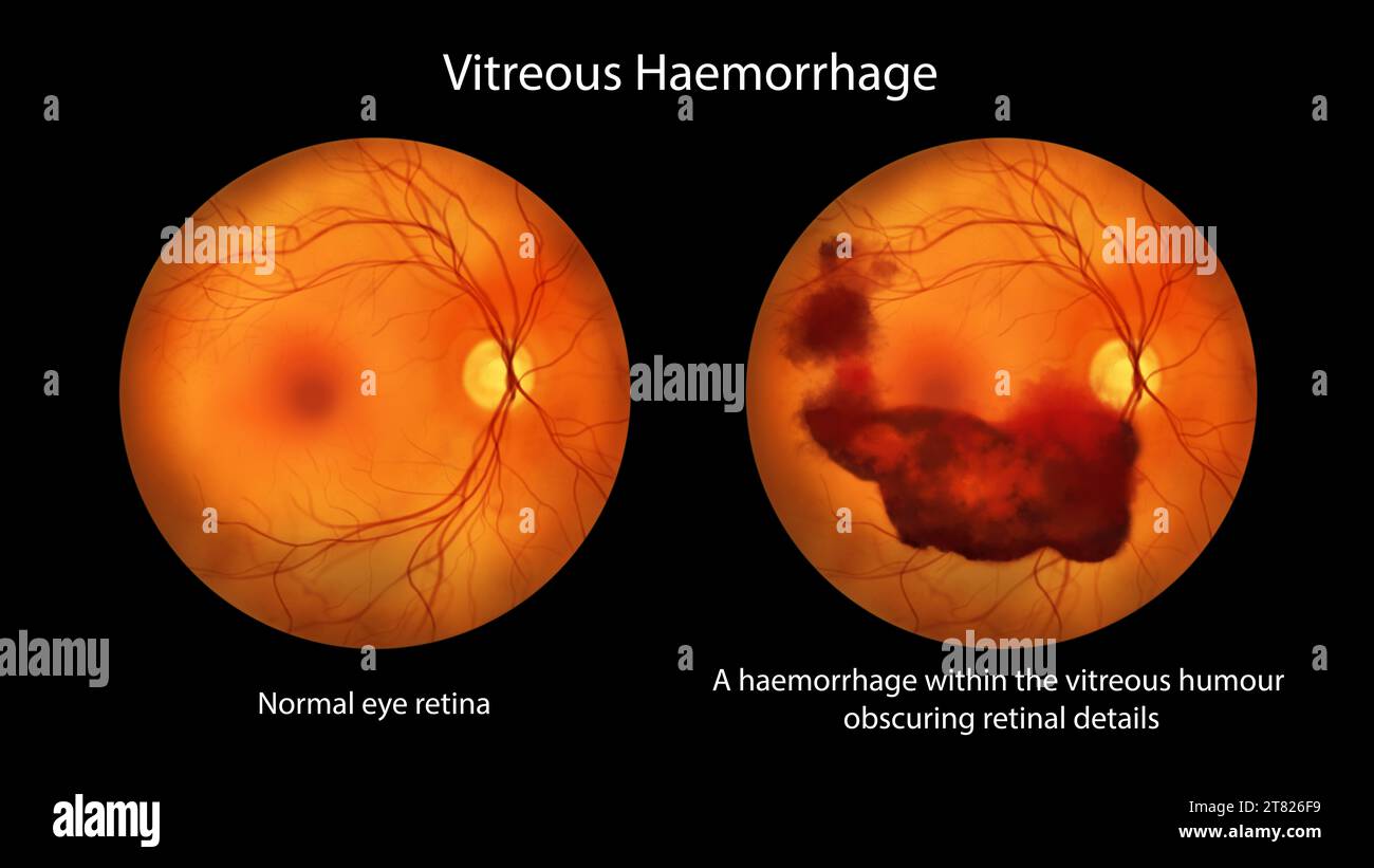 Vitreous haemorrhage, illustration Stock Photo - Alamy