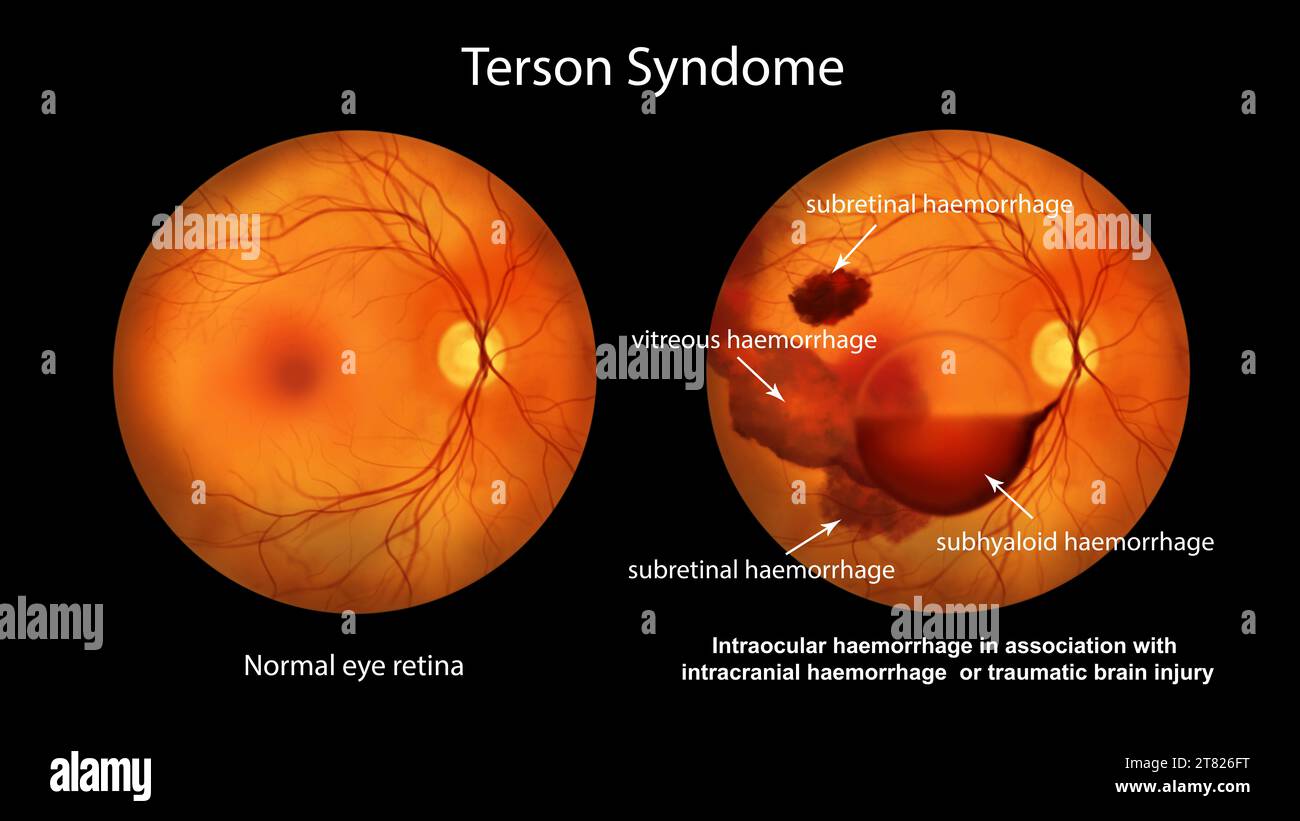 Illustration depicting Terson syndrome, revealing intraocular ...