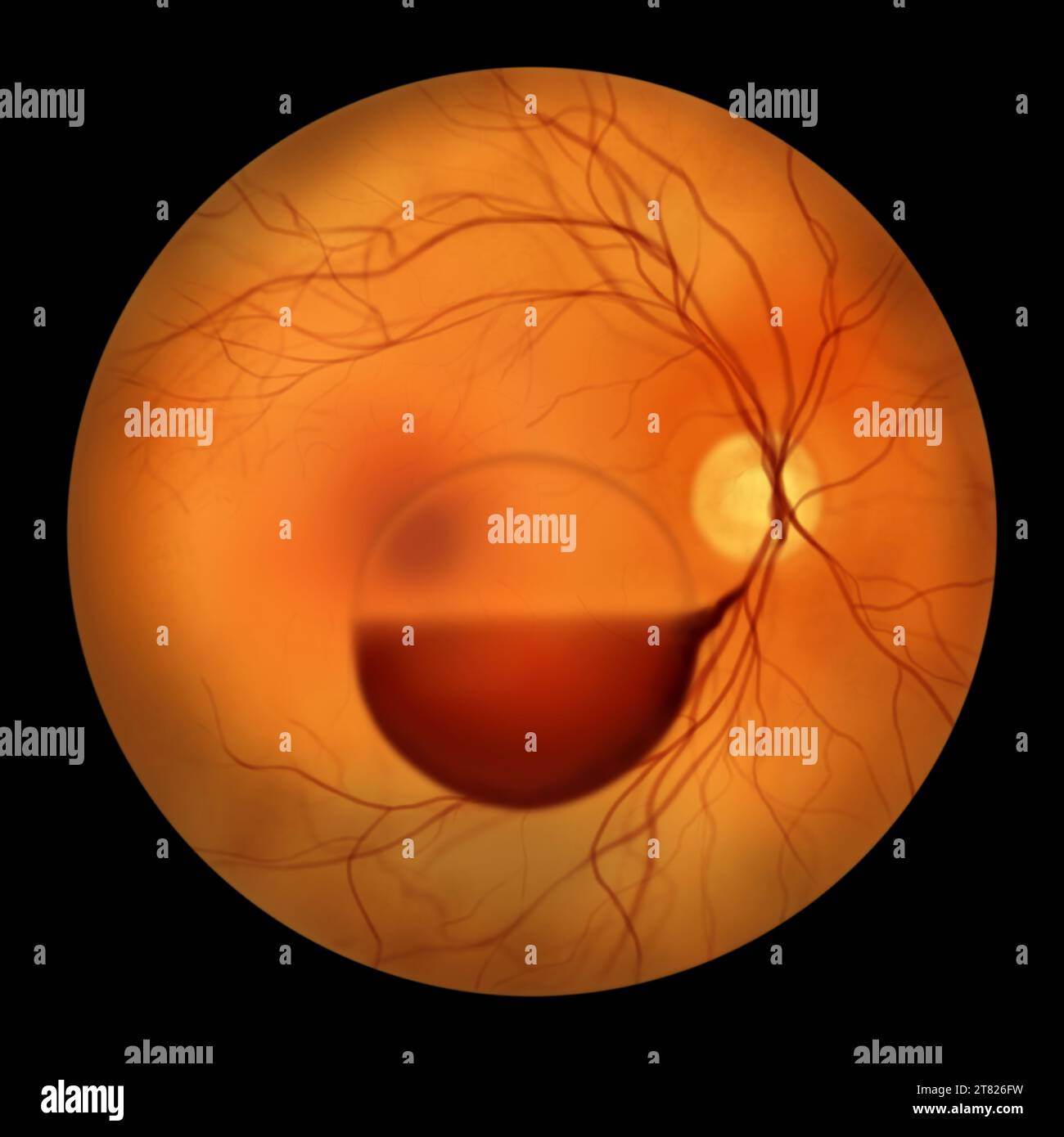 Illustration of a subhyaloid haemorrhage on the retina as observed ...