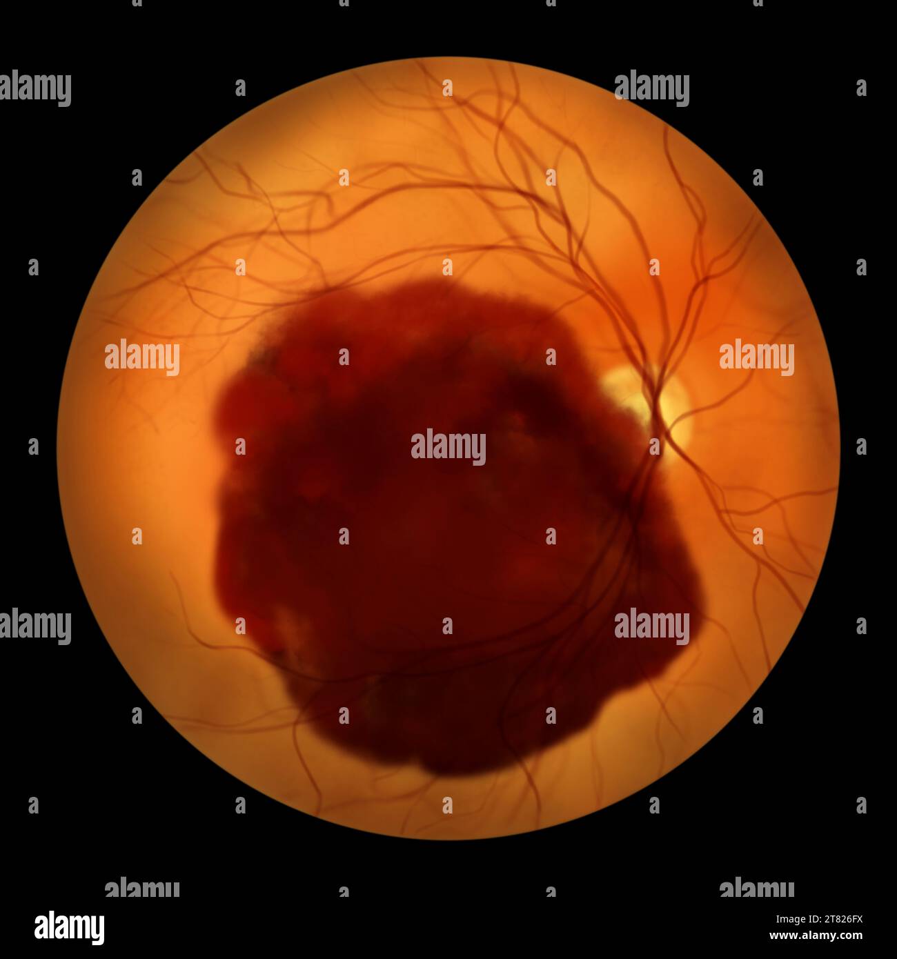 Subretinal haemorrhage, illustration Stock Photo - Alamy