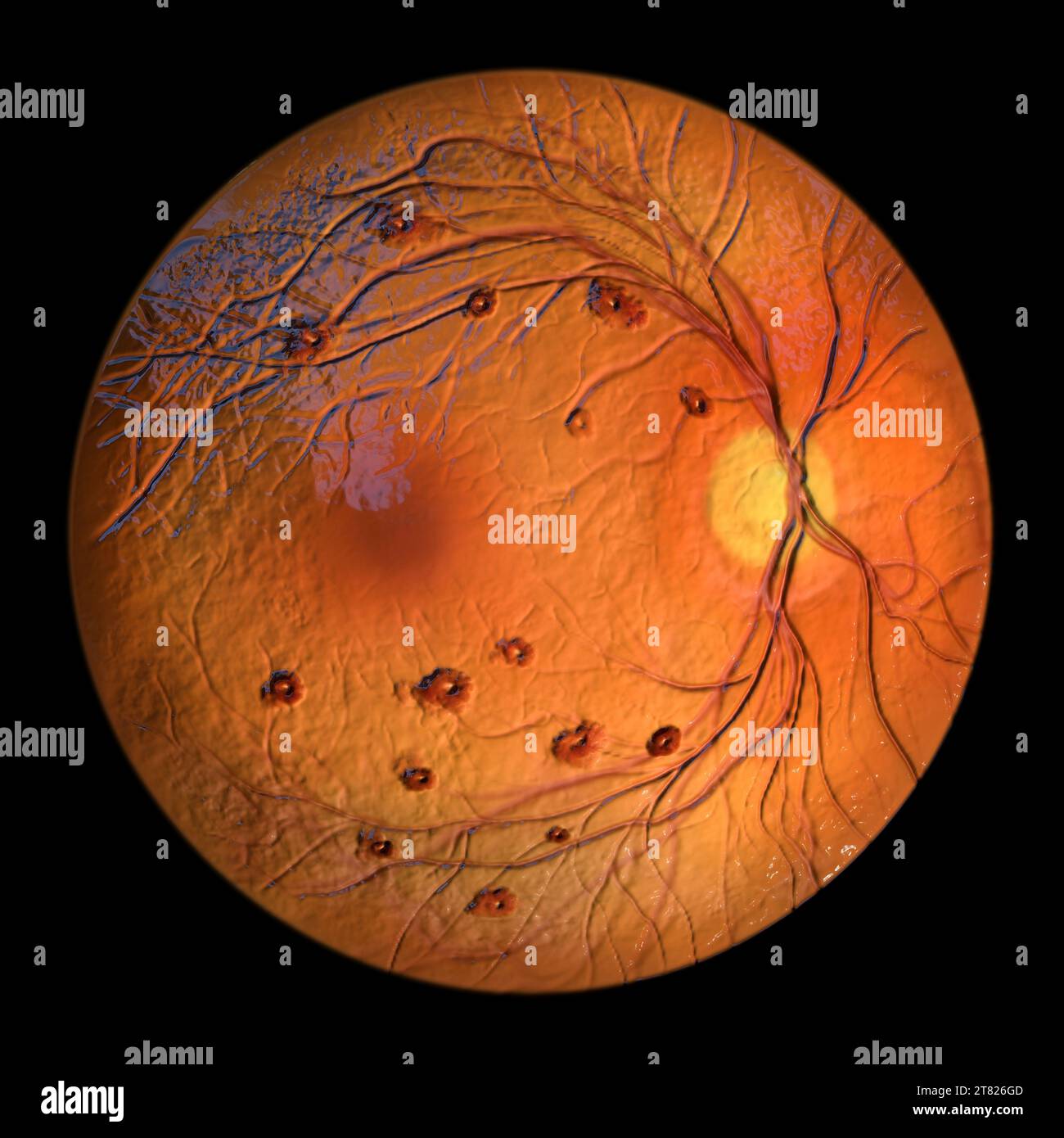 Roth spots in the retina, illustration Stock Photo - Alamy