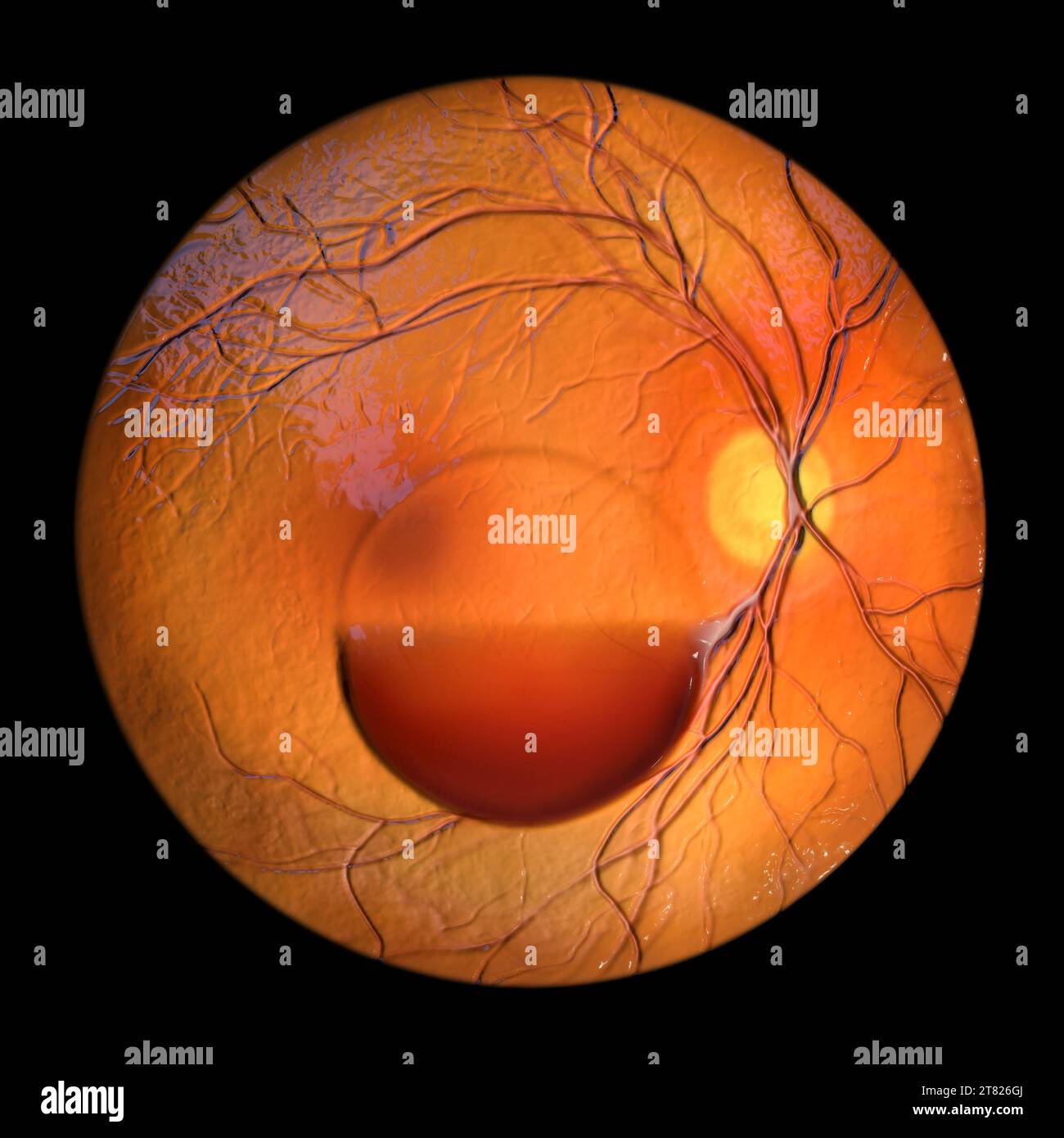 Illustration of a subhyaloid haemorrhage on the retina as observed ...
