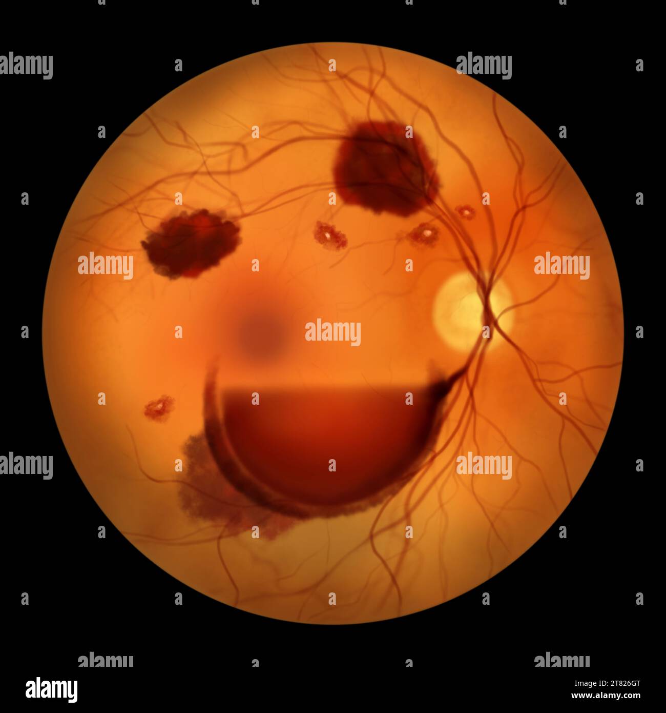 Intraocular haemorrhage in Terson syndrome, illustration Stock Photo ...