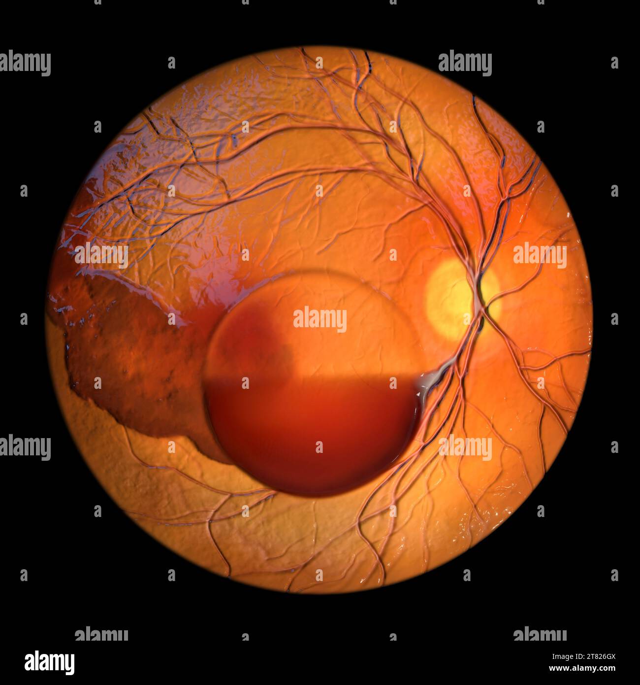 Intraocular haemorrhage in Terson syndrome, illustration Stock Photo ...