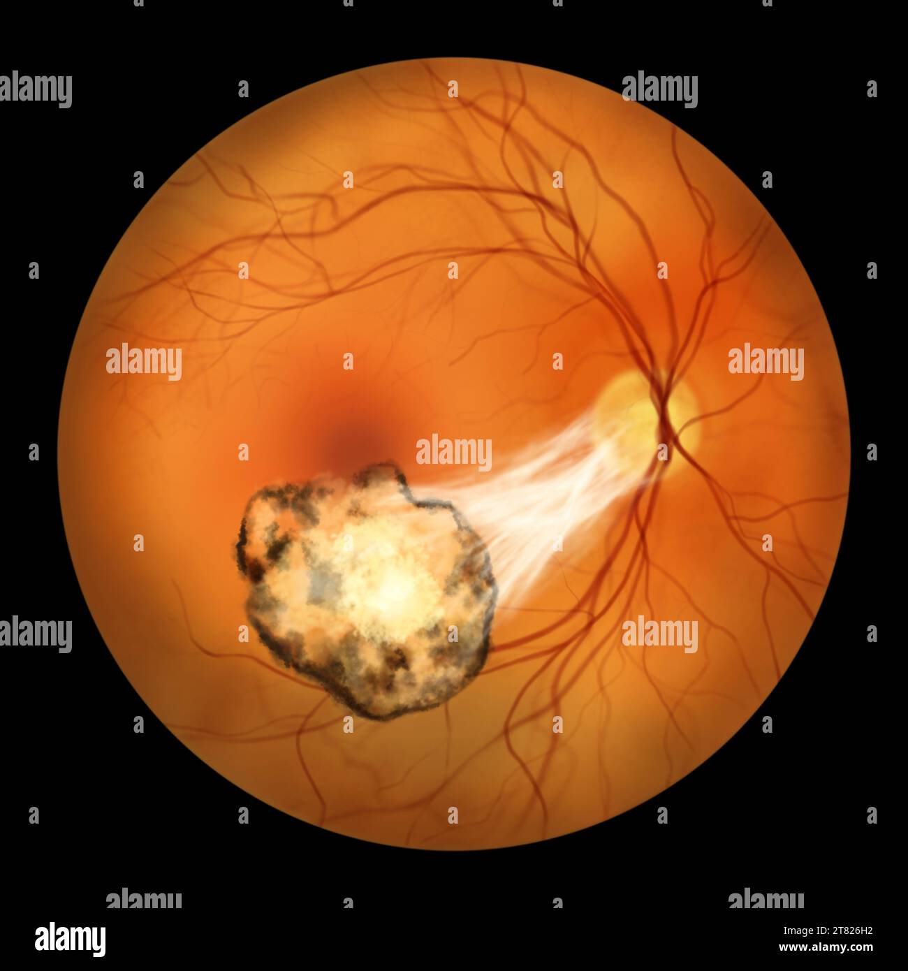 Illustration depicting Toxoplasma retinochoroiditis observed during ...