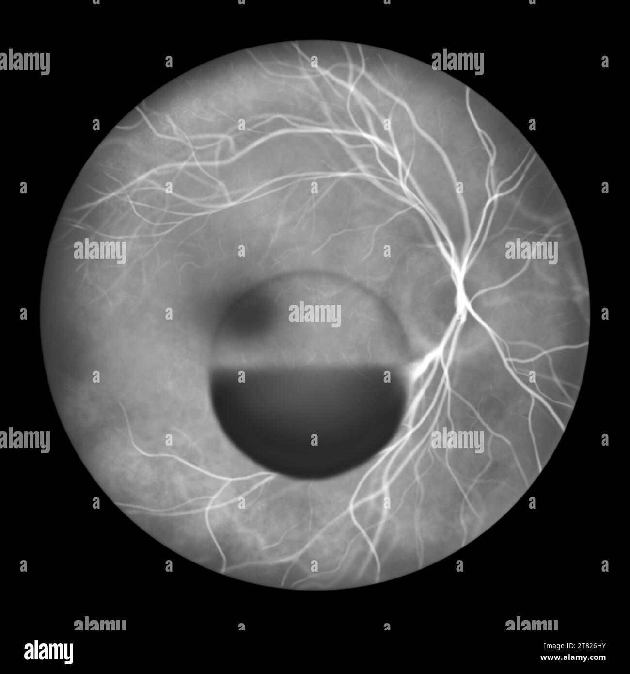 Illustration of a subhyaloid haemorrhage on the retina as observed ...