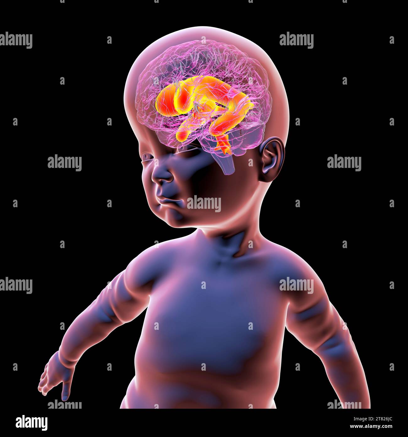 Computer illustration of a baby with macrocephaly and enlarged lateral ...