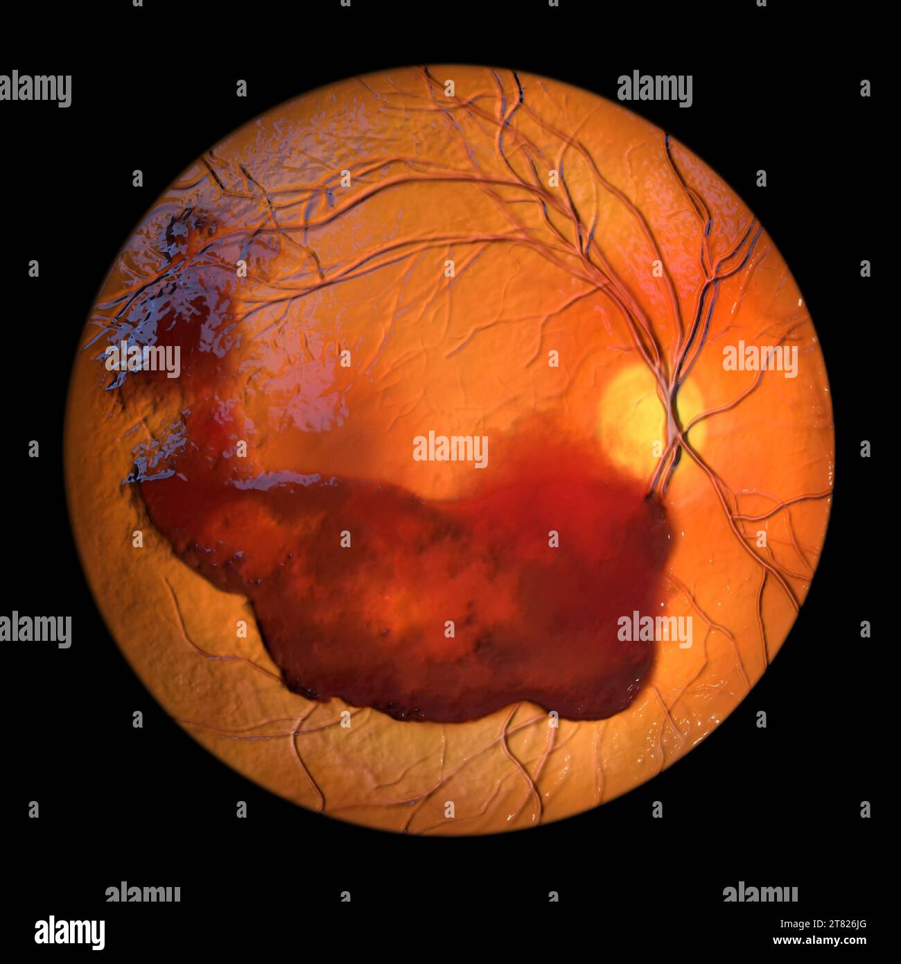 Vitreous haemorrhage, illustration Stock Photo - Alamy