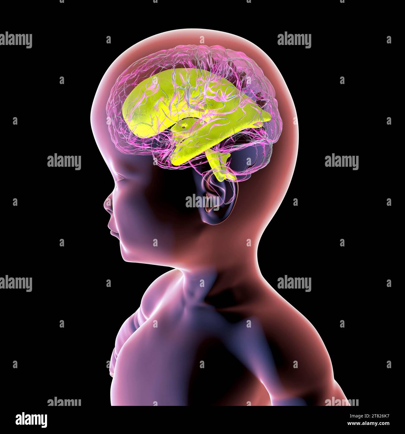 Computer illustration of a baby with macrocephaly and enlarged brain ...
