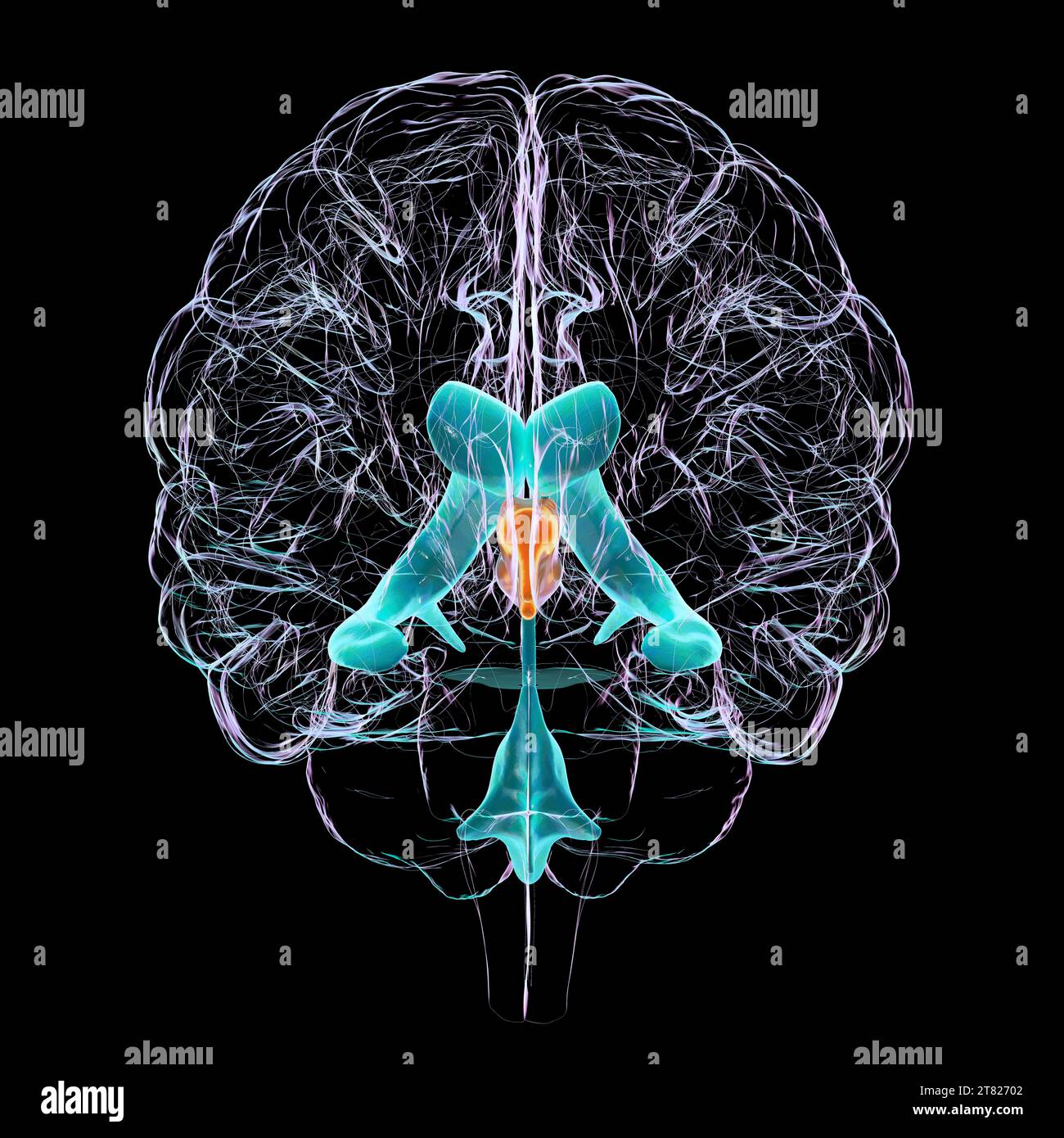 Enlarged third ventricle of the brain, illustration Stock Photo - Alamy