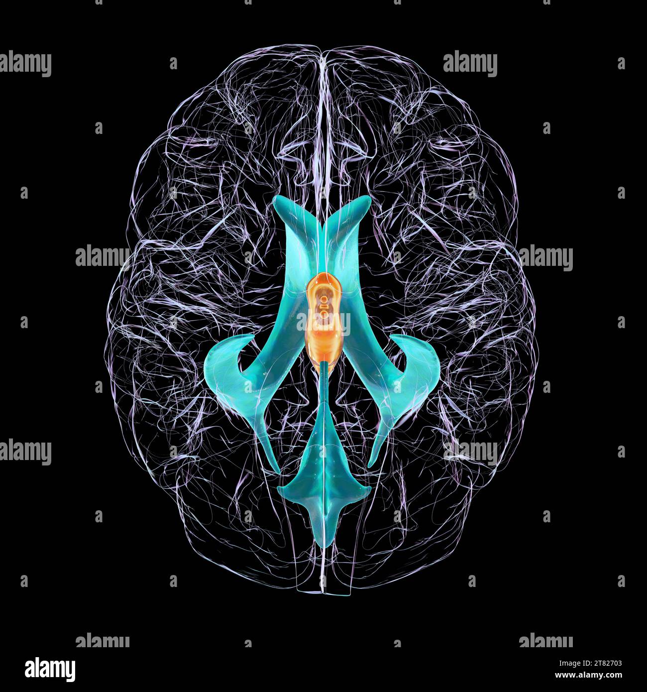 Enlarged third ventricle of the brain, illustration Stock Photo - Alamy