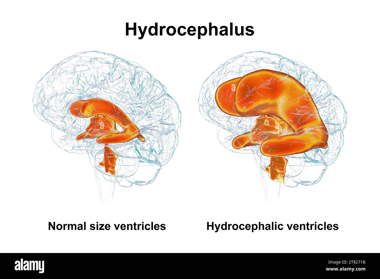 Enlarged and normal brain ventricles, illustration Stock Photo - Alamy