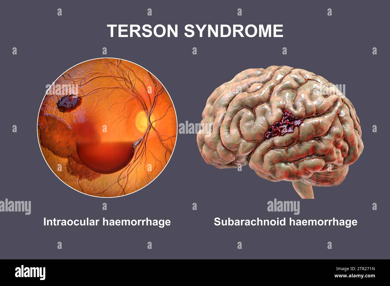 Computer illustration depicting Terson syndrome, revealing intraocular ...