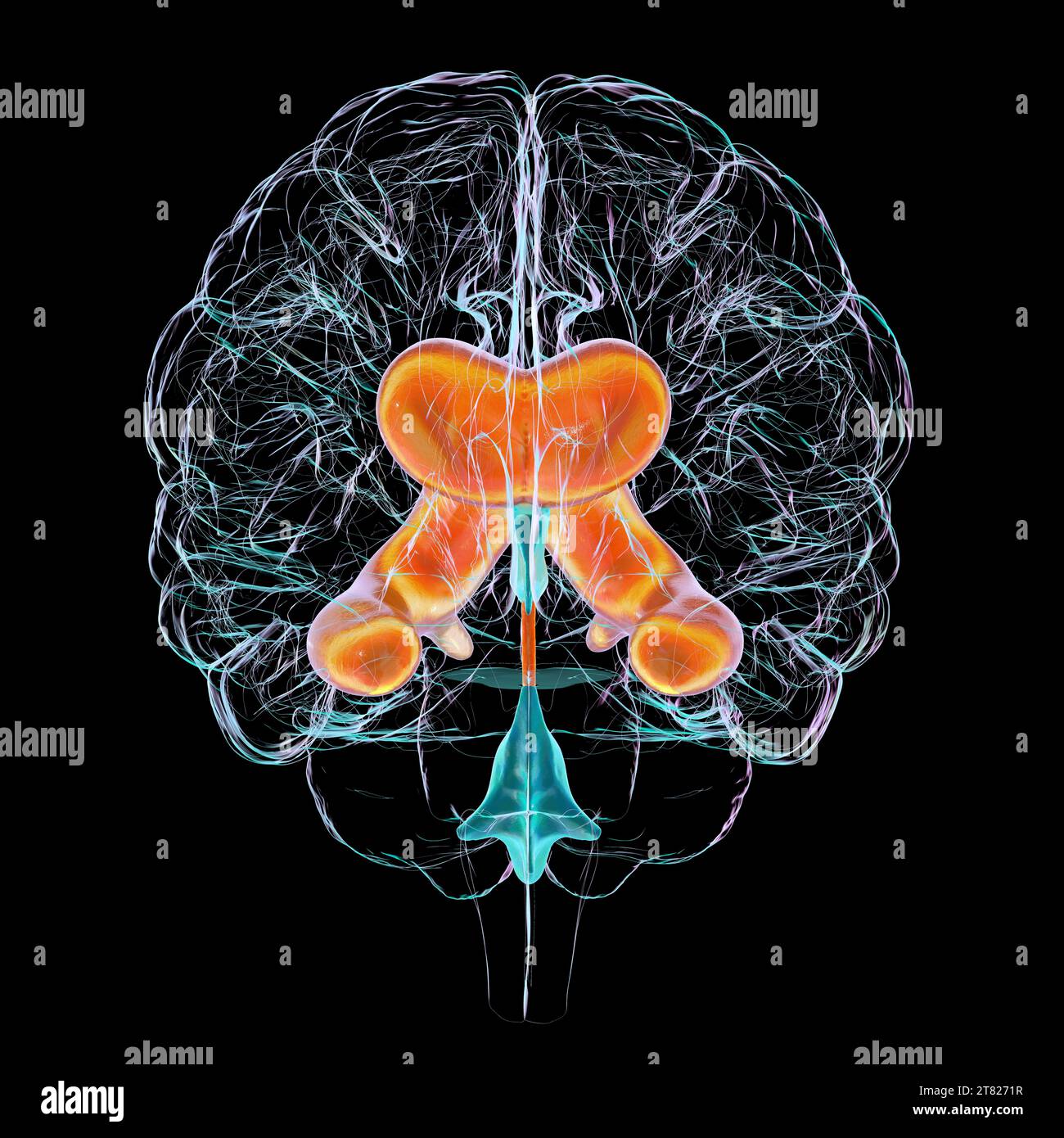 Computer illustration depicting enlarged lateral ventricles ...