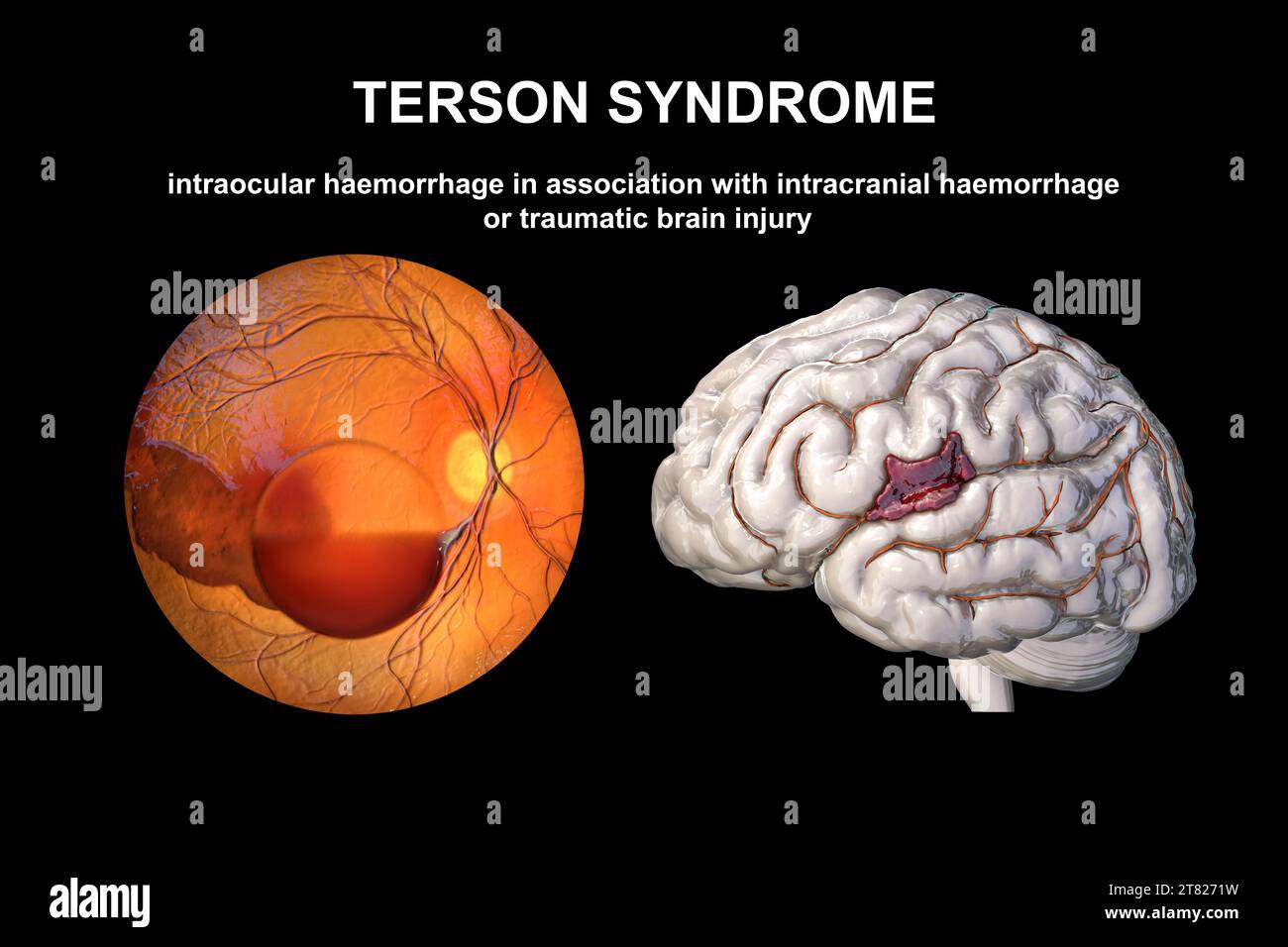 Terson syndrome, illustration Stock Photo - Alamy