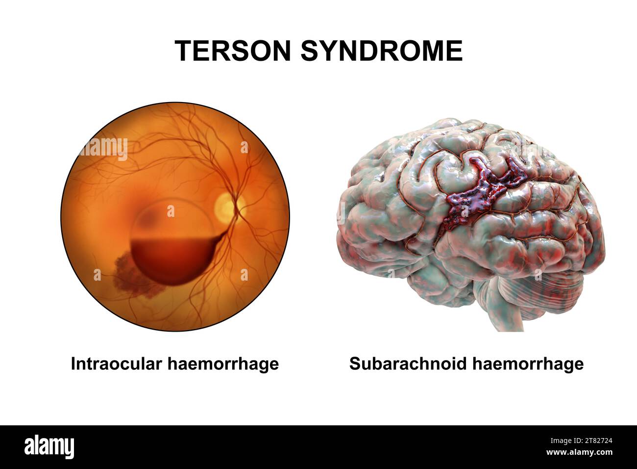 Computer illustration depicting Terson syndrome, revealing intraocular ...