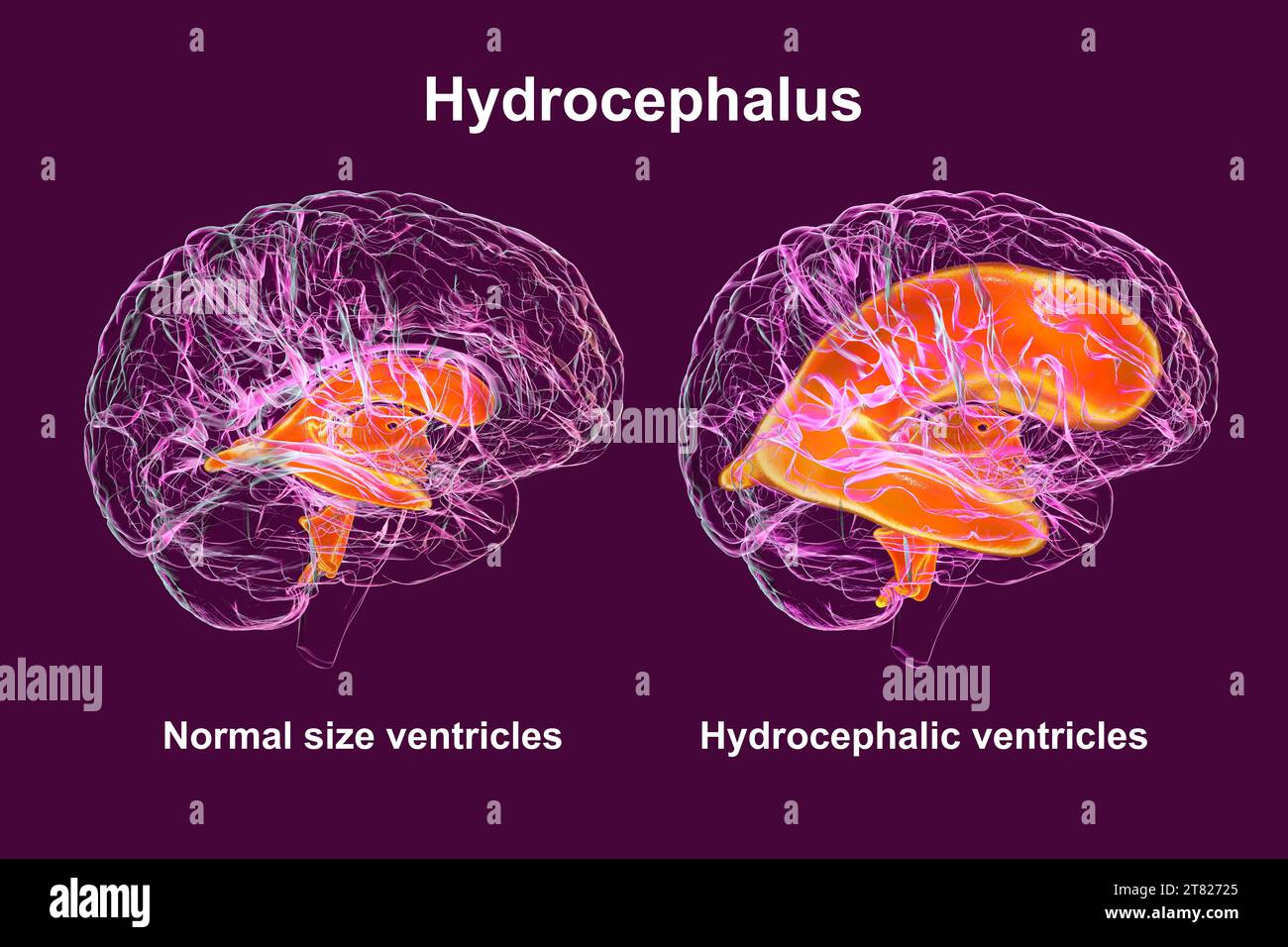 Enlarged and normal brain ventricles, illustration Stock Photo - Alamy