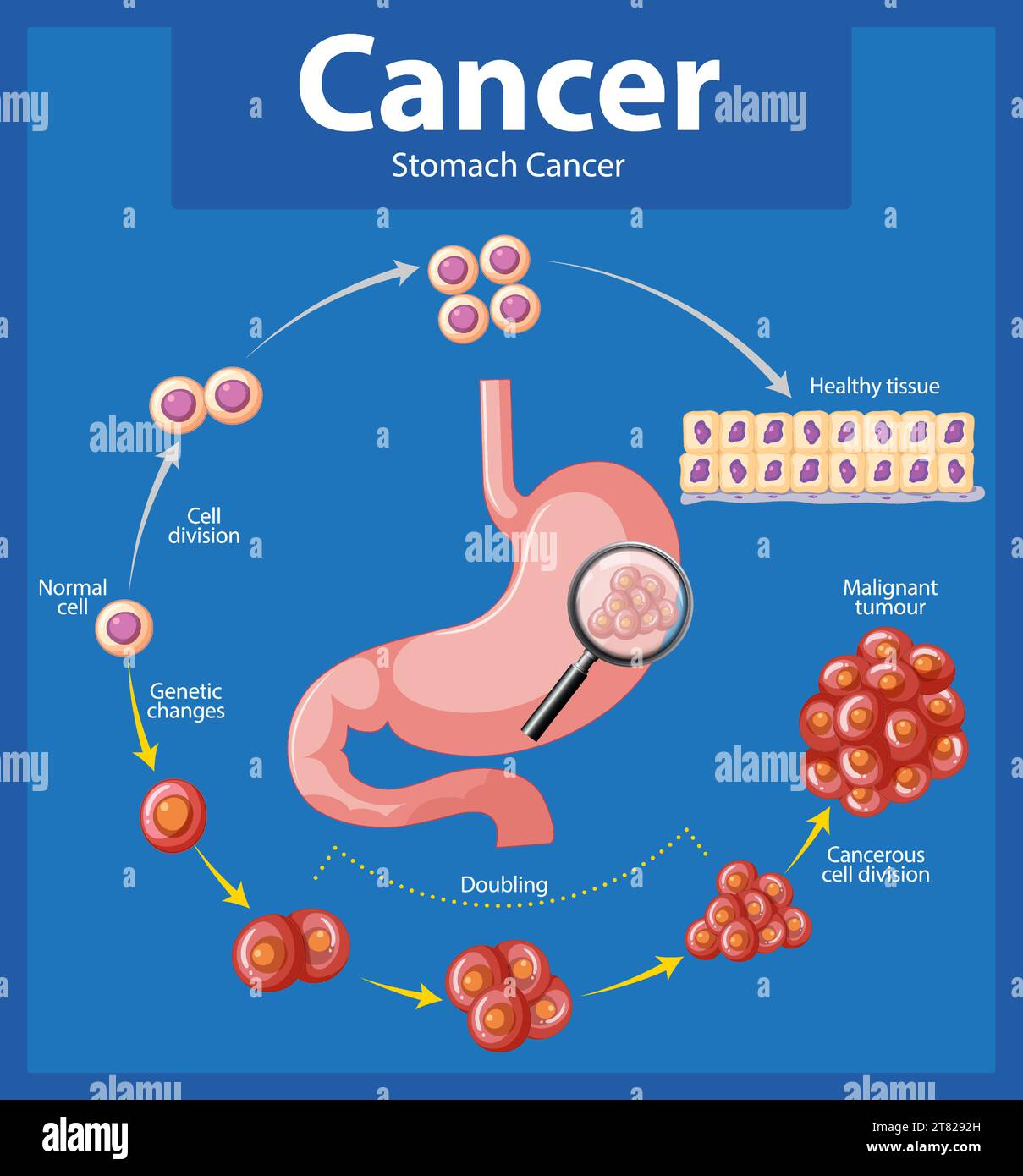 Illustrated infographic depicting abnormal cell growth in stomach ...