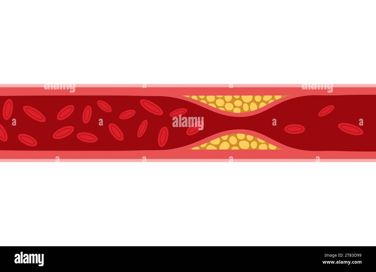 Cholesterol artery thrombosis micro vascular disease. Arteriosclerosis ...