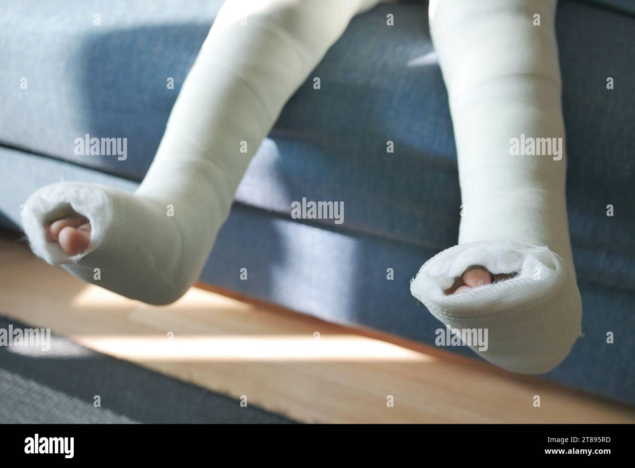 little child with plaster bandage on leg Stock Photo - Alamy