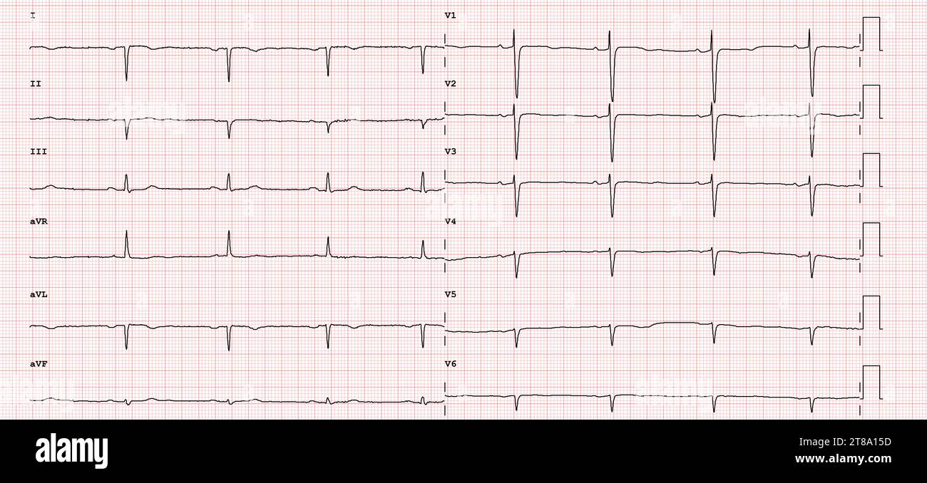 ECG example of right axial deviation of the heart 12-lead rhythm Stock Photo - Alamy