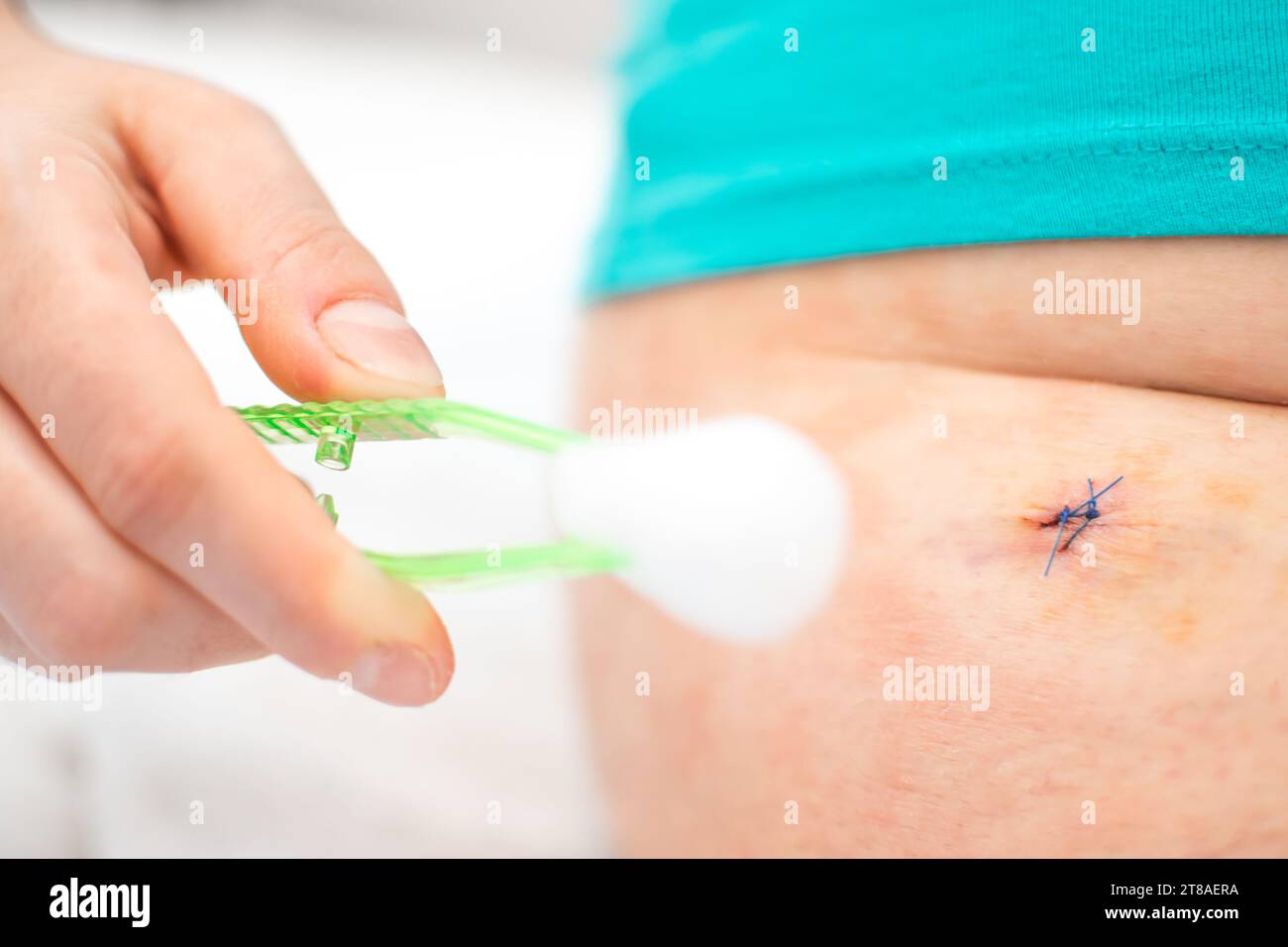 Sewing up surgical wound hi-res stock photography and images - Alamy
