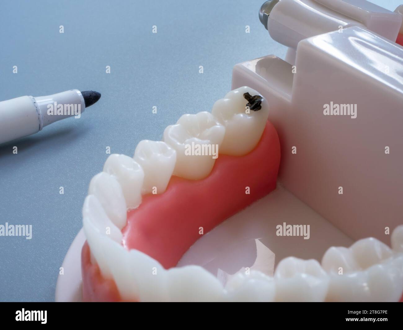 Model of a human jaw and tooth marked as a sign of caries. Dental ...
