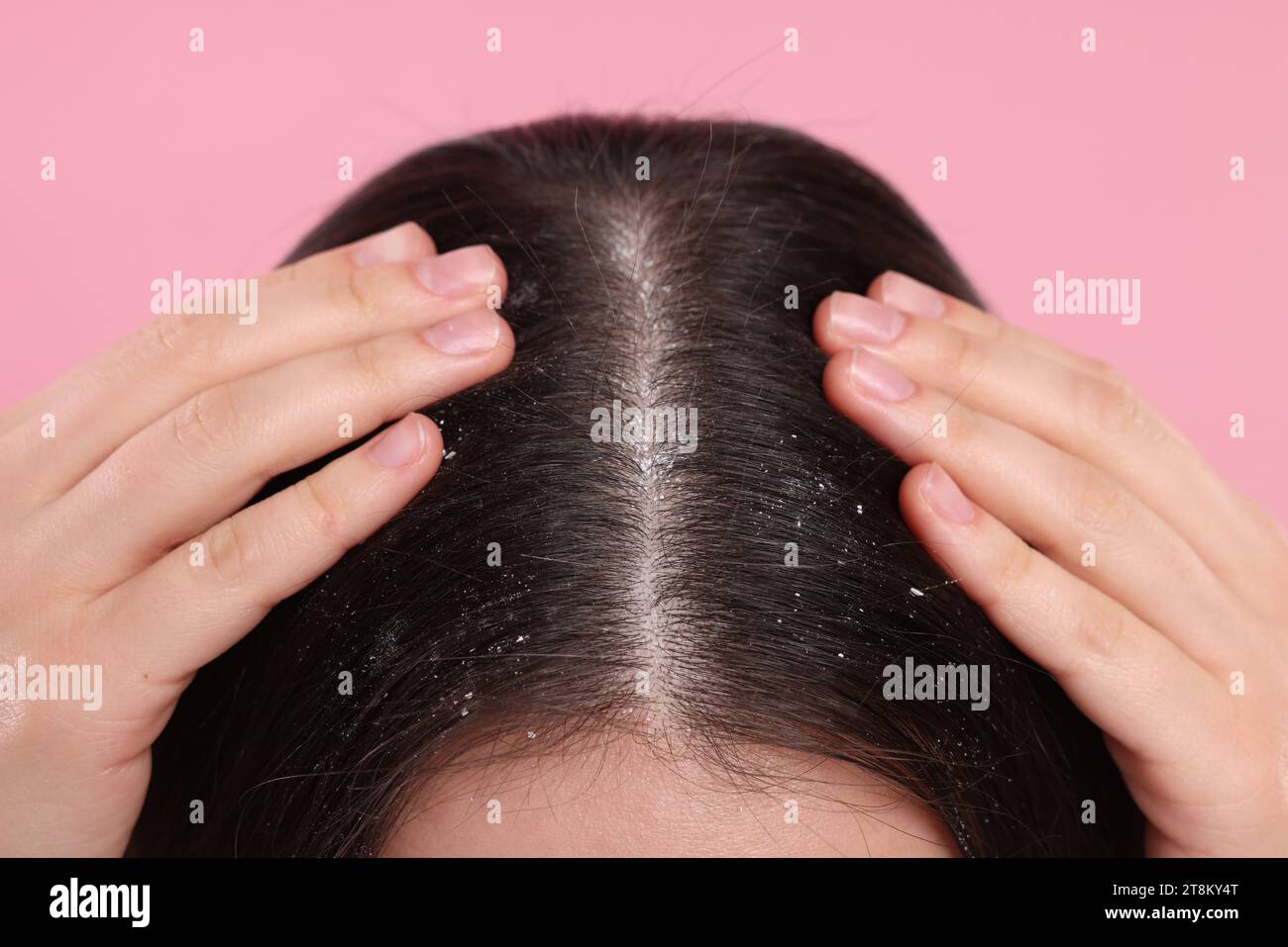 Woman with dandruff problem on pink background, closeup Stock Photo - Alamy
