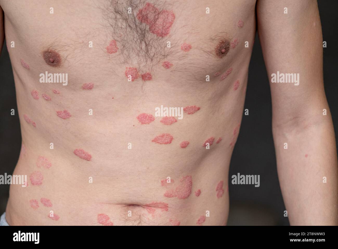 Psoriasis Vulgaris, skin patches are typically red, itchy, and scaly ...