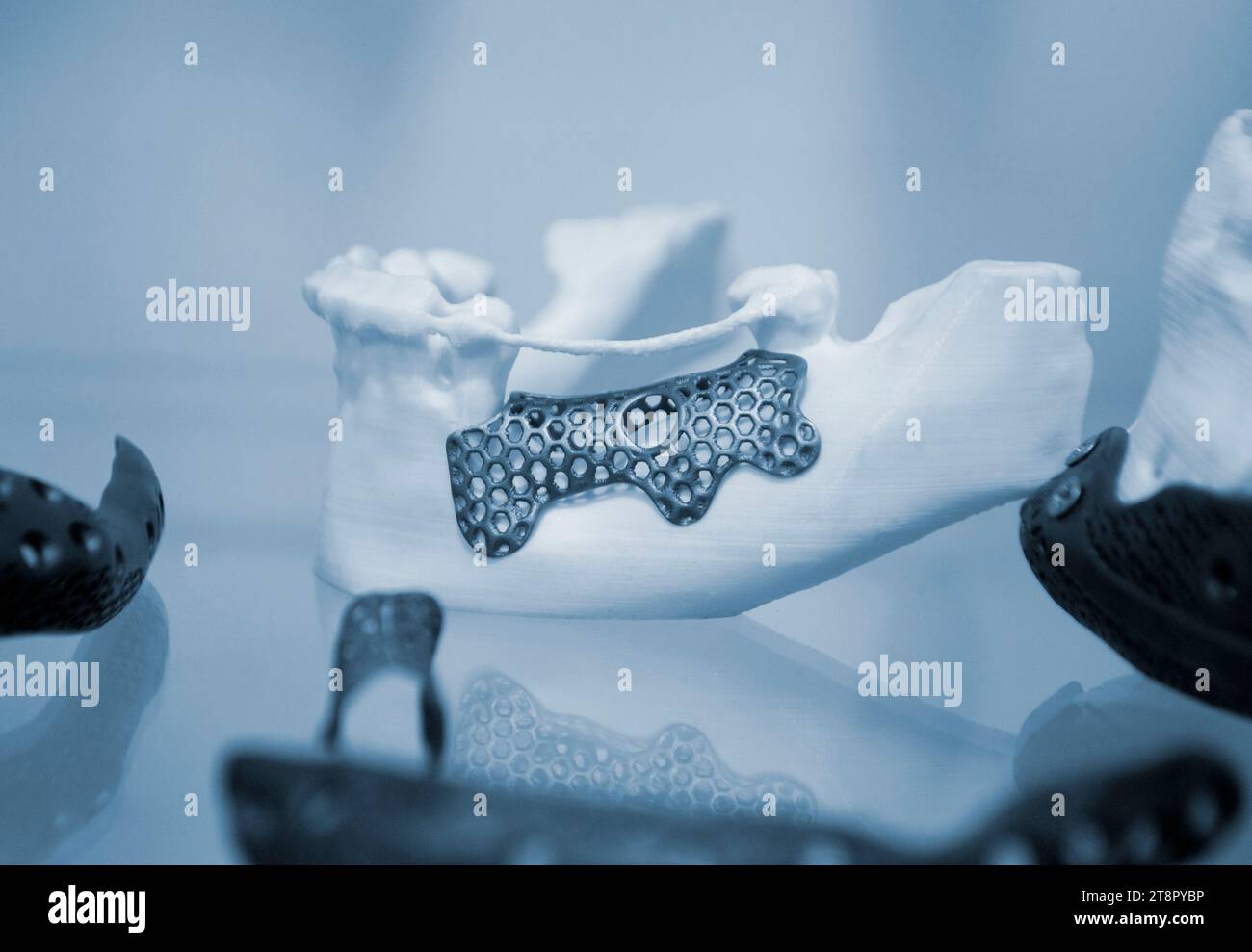 Facial bone of lower human jaw individual prosthesis printed on 3D ...