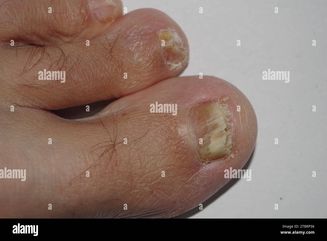 Fungal toenail does hi-res stock photography and images - Alamy