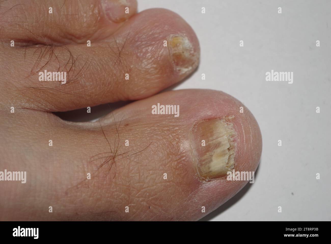 Fungal toenail infection Stock Photo - Alamy