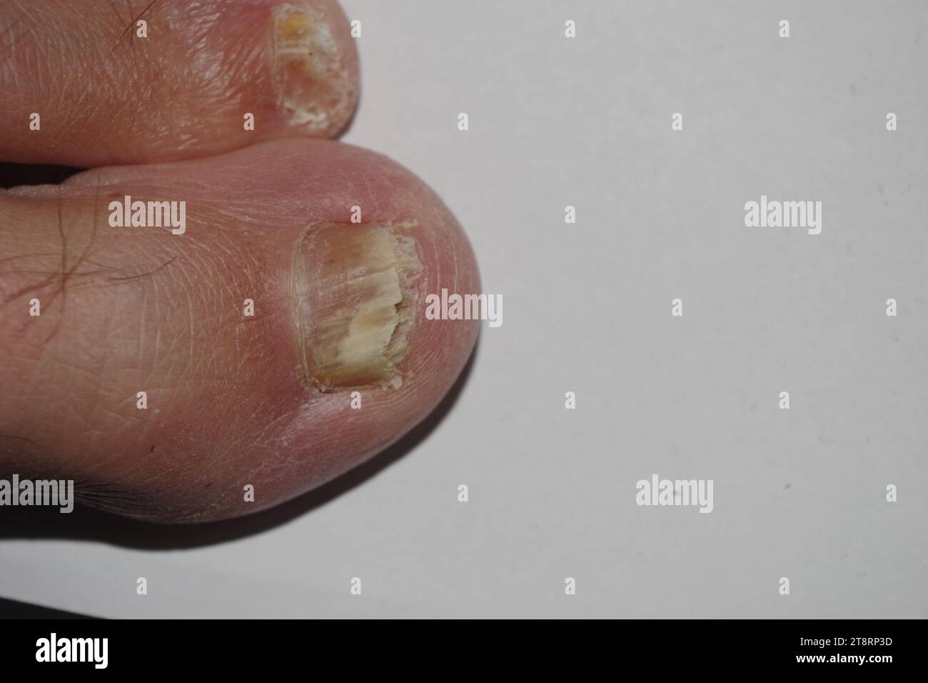 Fungal toenail hi-res stock photography and images - Alamy
