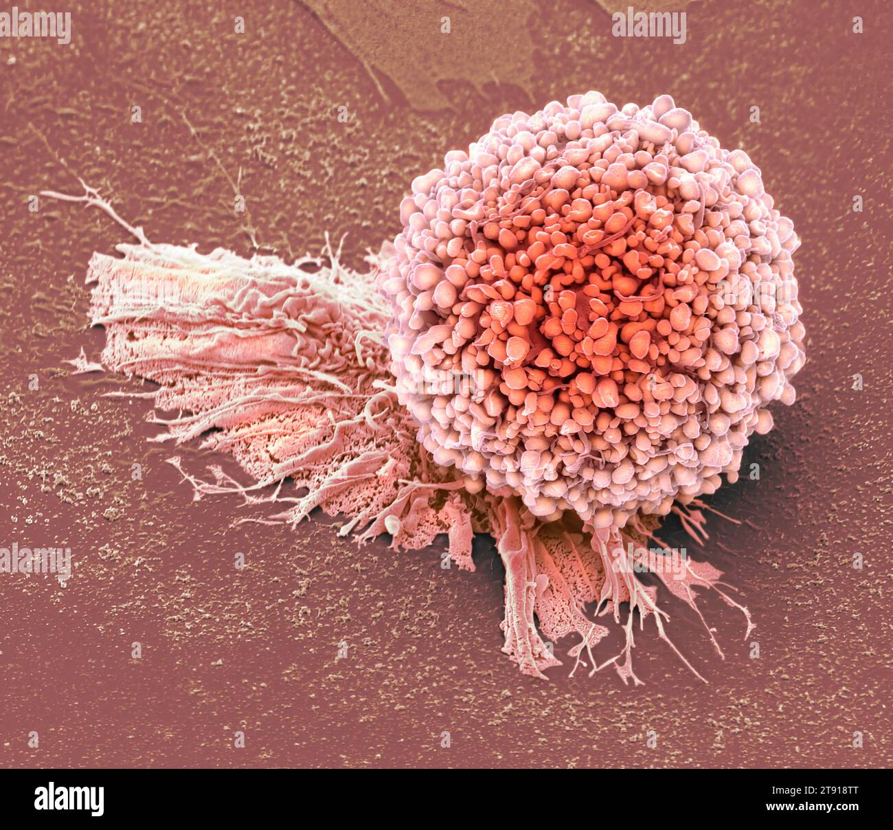 Cervical cancer cell, SEM Stock Photo - Alamy