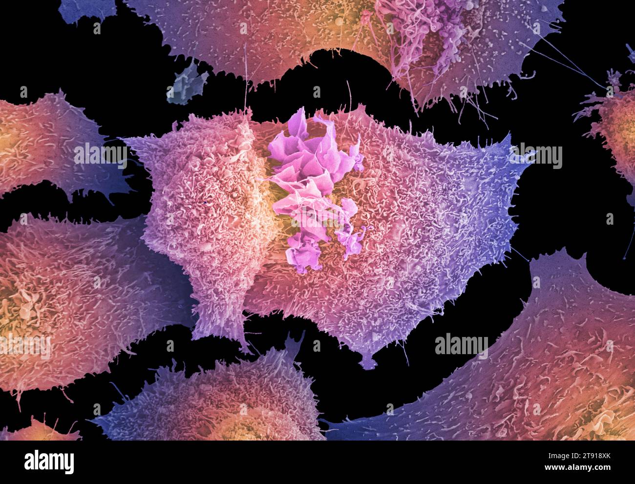 Lung cancer cells, SEM Stock Photo - Alamy