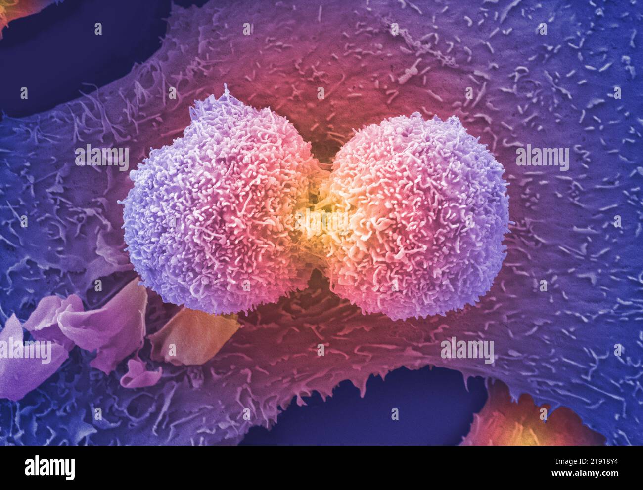 Lung cancer cells dividing, SEM Stock Photo - Alamy