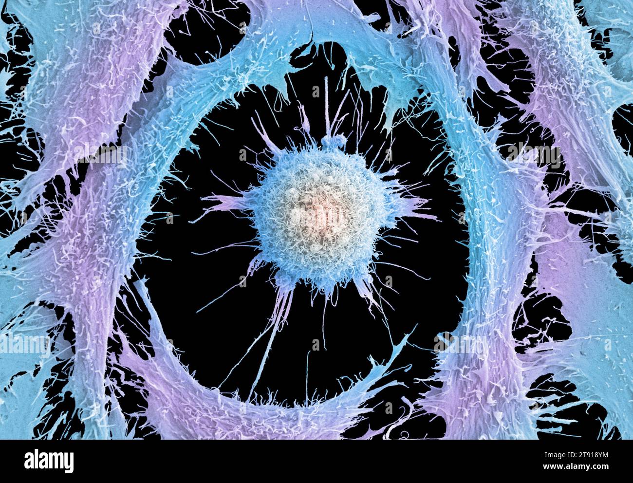 Cervical cancer cells, SEM Stock Photo - Alamy