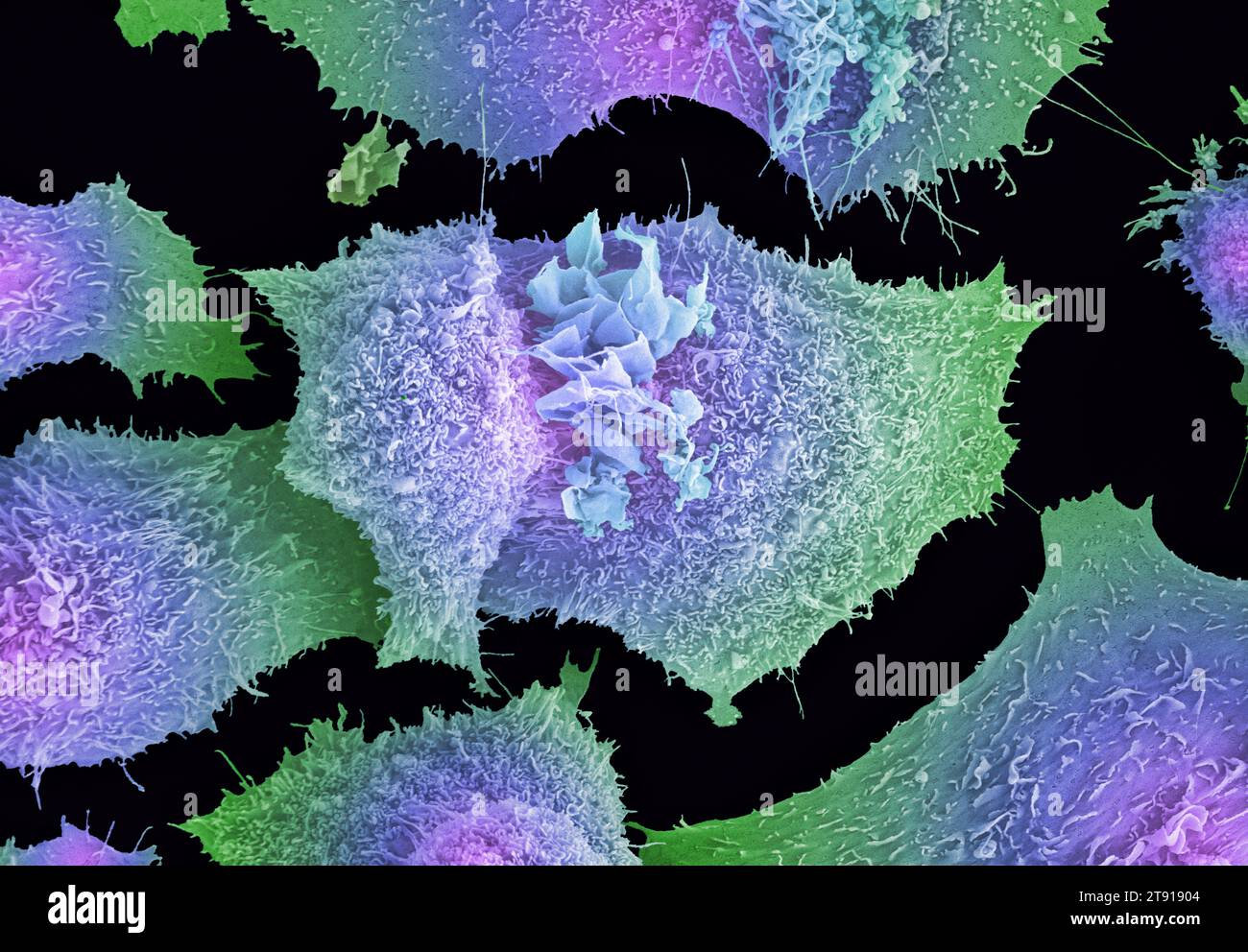 Lung cancer cells, SEM Stock Photo - Alamy