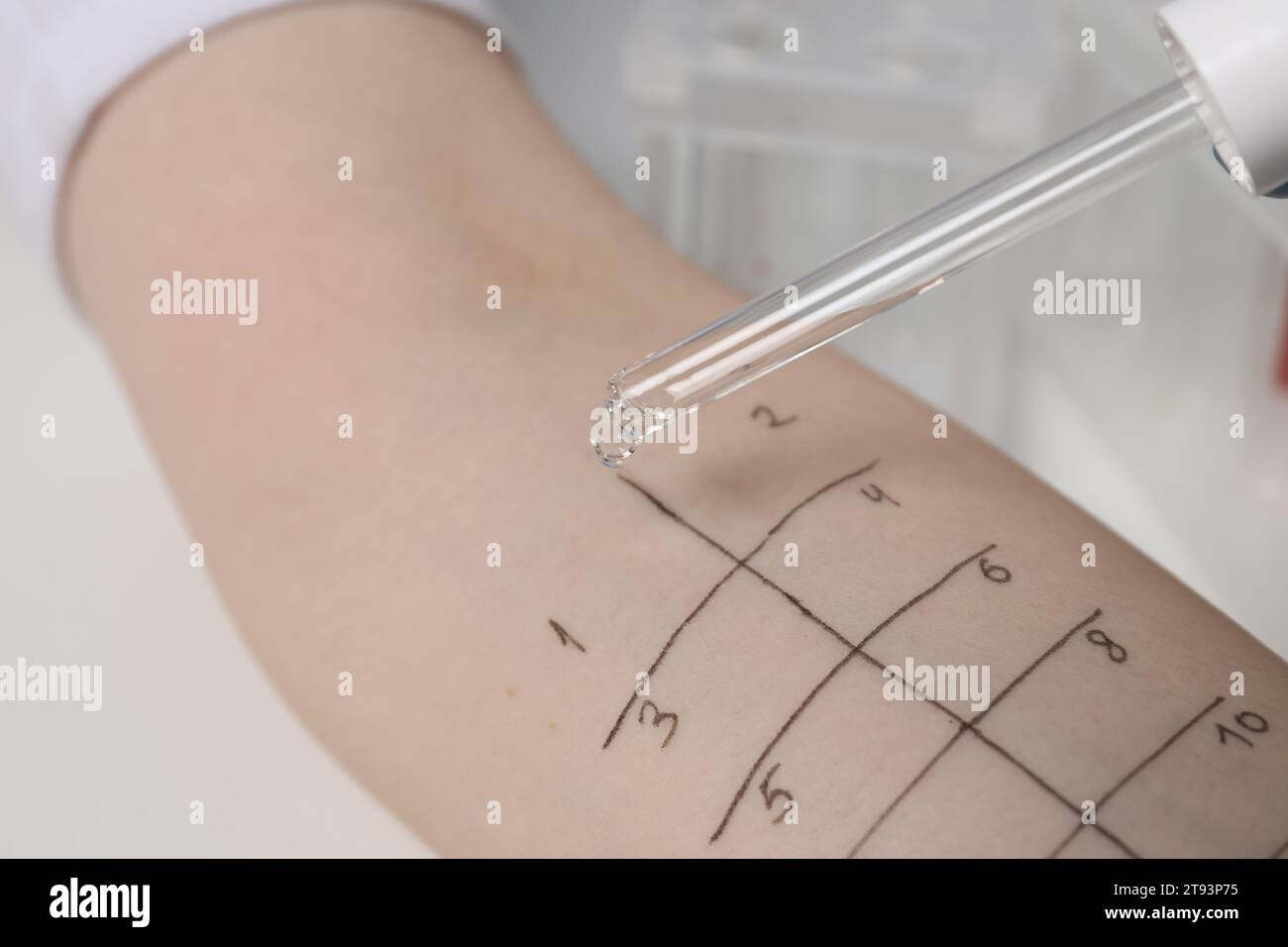 Patient undergoing skin allergy test at light table in clinic, closeup ...