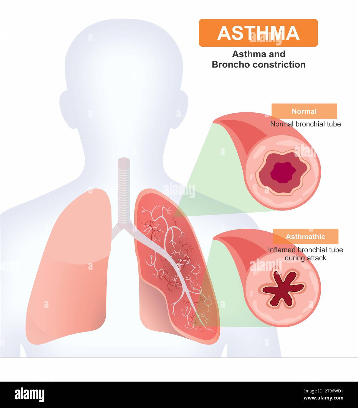 Asthma and Broncho constriction c section medical illustration Stock ...