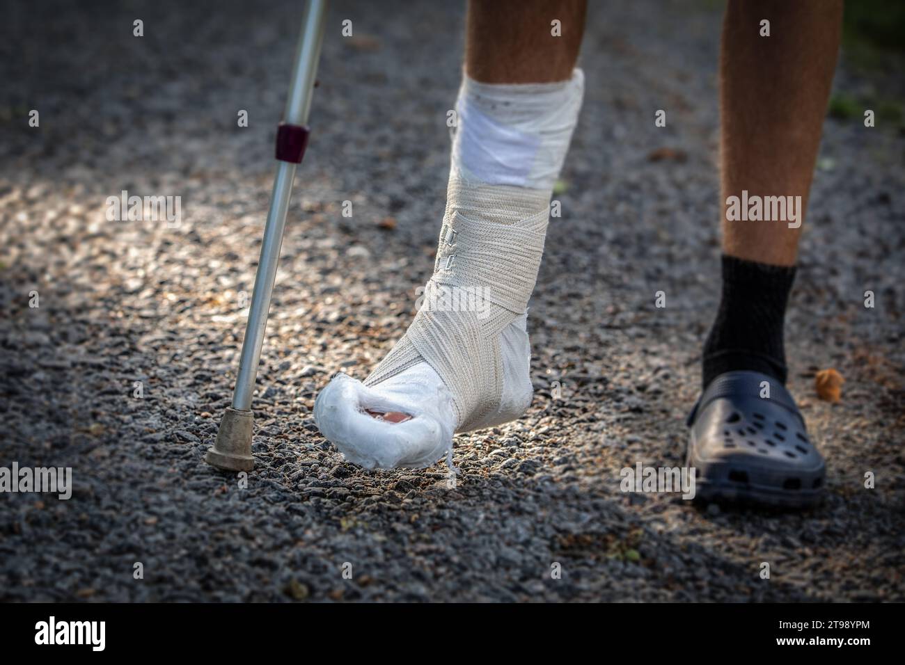 Broken ankle and a leg cast. Leg splint Stock Photo - Alamy