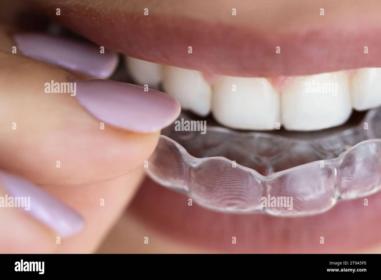 Clear Dental Aligner Aligners: Night Guard for Alignment Stock Photo ...