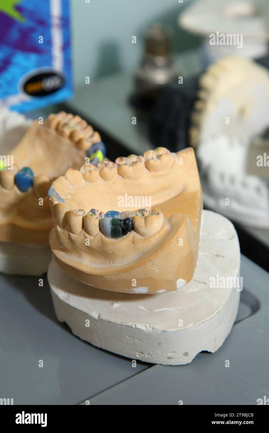 Fabrication of dental crowns and dentures made of ceramic. Scanning of ...
